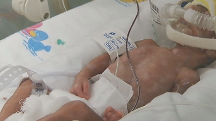 Study Finds Prenatal Steroids Can Help Preterm Babies As Early As 23 ...