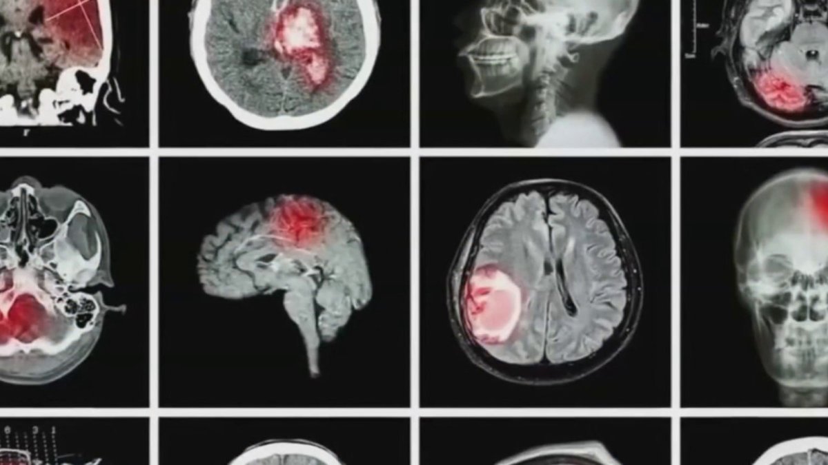 University of Miami Doctor on How to Identify Symptoms of a Stroke ...