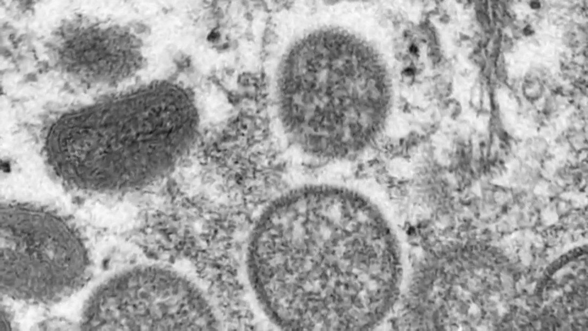 US Officials to Declare Monkeypox a Public Health Emergency – NBC 6 ...